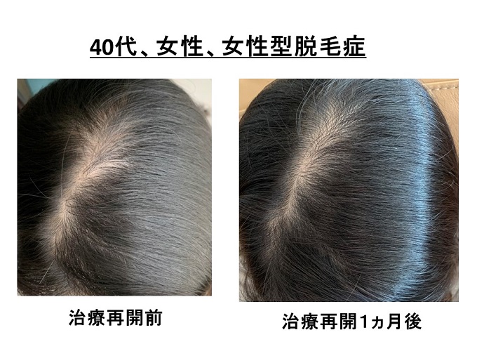 女性型脱毛症の患者様、治療再開1ヵ月で髪の艶が明らかに改善！ 患者様からの声・メディア掲載・クリニックからのお知らせ 名古屋kクリニック